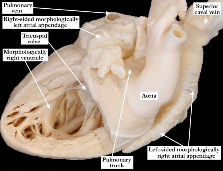 01.03.01 - Atrial situs inversus - ISNPCHD