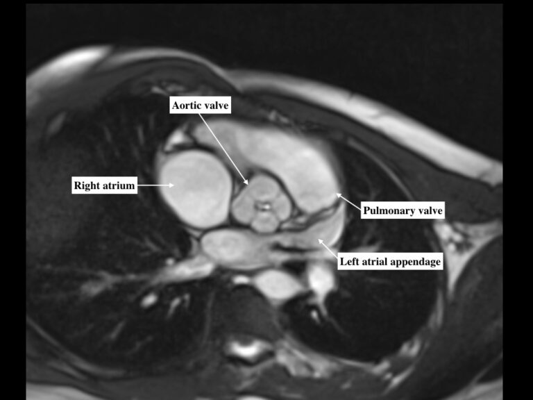 09.15.19 - congenital anomaly of aortic valve - ISNPCHD